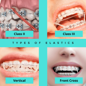 What Are Interarch Rubber Bands